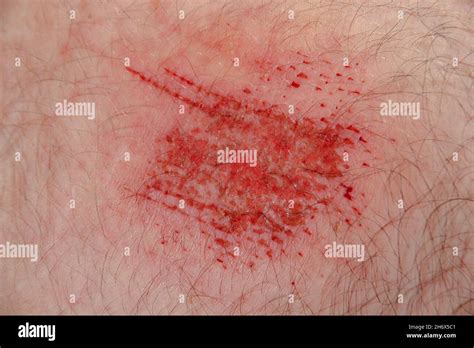 Example Of Abrasion Injury At Ellen Martinez Blog
