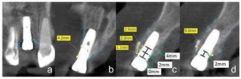Frozen Stored Teeth Autogenous Dentin As An Alternative Augmentation
