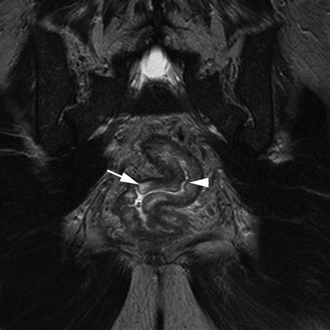 Mri Of Rectal Disorders Ajr