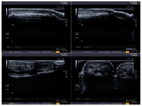 Imaging In Diagnosis Of Systemic Sclerosis PMC