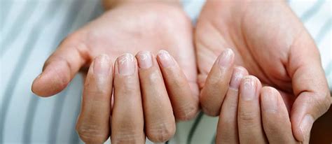 Tips For Dealing With Nails For People With Psoriasis Or Eczema