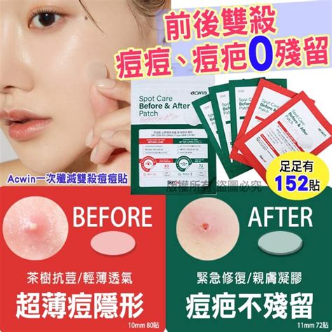 韓國 Acwin 早晚替換大容量痘痘貼最新升級款！一次殲滅雙殺痘痘貼152貼 袋 蝦皮購物