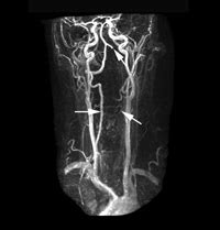 Dental Procedures And Stroke A Case Of Vertebral Artery Dissection Jcda