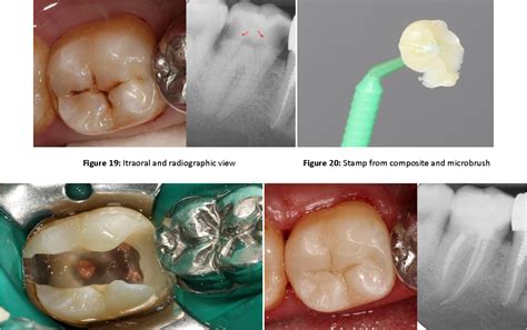 Dentist Composite Technique At Peggy Bradley Blog