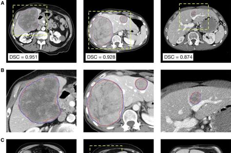 Hmn 2025 How Ai Instrument Automates Liver Tumor Detection And