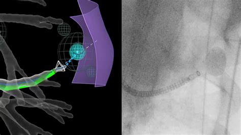 Ion Robotic Bronchoscopy Intuitive
