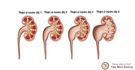 Thận Ứ Nước Là Gì Có Nguy Hiểm Không Triệu Chứng Và Điều Trị