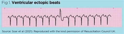 Electrocardiogram 3 Cardiac Rhythm And Conduction Abnormalities