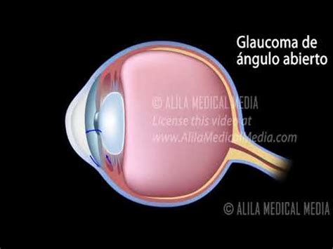 Glaucoma De Ángulo Abierto Y De Ángulo Cerrado Youtube