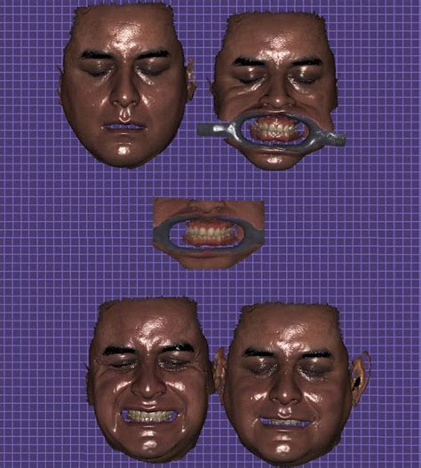 Exocad Smile Design Course 3d Implant Institute