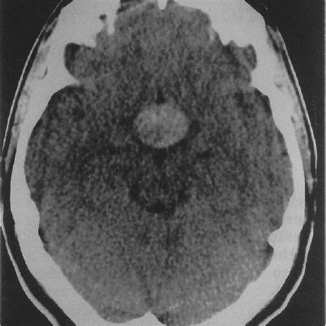 Figure Non Contrast Ct Scan Demonstrating A Midline Hyperdense Mass Download Scientific