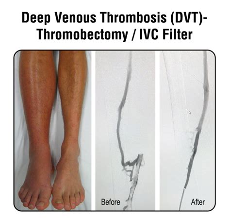 Deep Vein Thrombosis Ruge Vascular Centre Belagavi