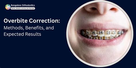 Overbite Correction Methods Benefits And Expected Results