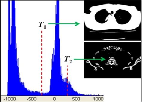 selection of thresholds in histogram of ct image and binary images by