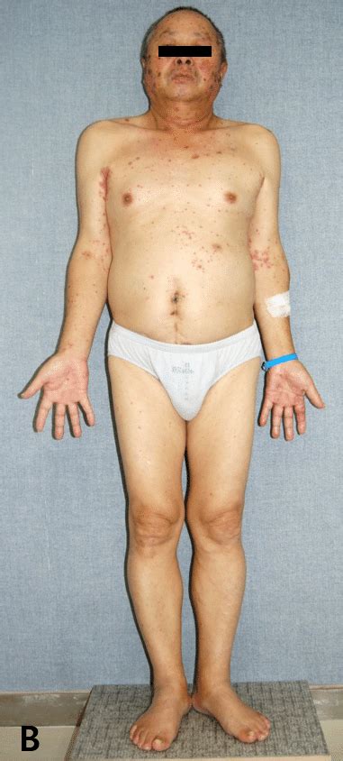 A Generalized Erythematous Scaly Papules And Patches On The Whole