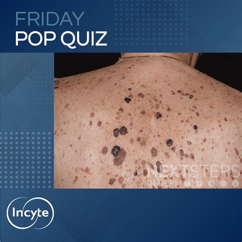 Benign Lesion Archives Next Steps In Dermatology