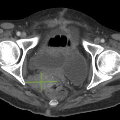 Sigmoidoscopic View Showing Patent Rectosigmoid Junction After Stent Download Scientific