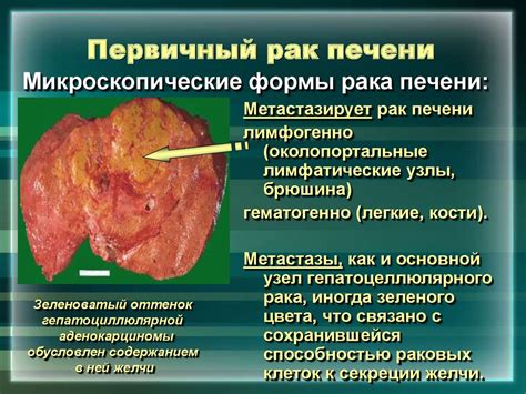 Заболевания печени презентация онлайн