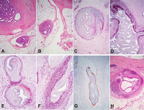 Case 2 Endometriosis Within Vessels And Lymph Nodes Intravascular