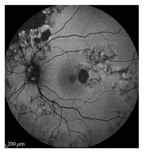 Fundus Autofluorescence Image Of Left Eye Of A Male Patient With Download Scientific Diagram