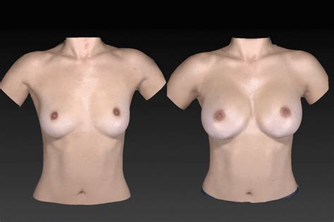 Patient 104431219 Breast Augmentation Before And After Photos Steven
