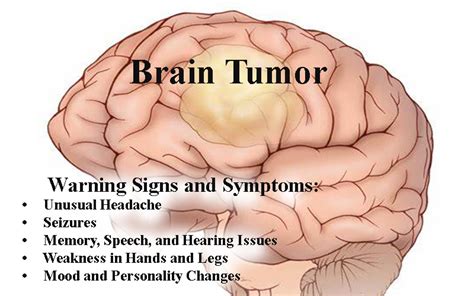 First Signs Of Brain Tumor