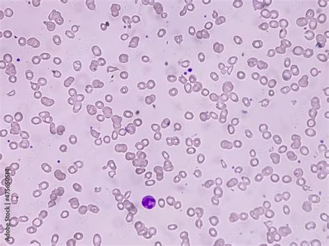 Macrocytic Anemia With Features Of Hemolysis And Nucleated Rbc Analyzed By Microscope Stock