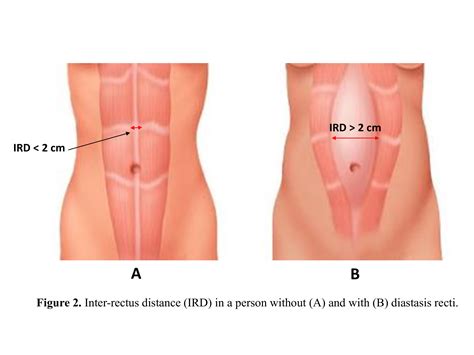 An Overview Of The Management Of Diastasis Of The Rectus Abdominal