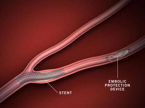 Embolic Protection Devices Market