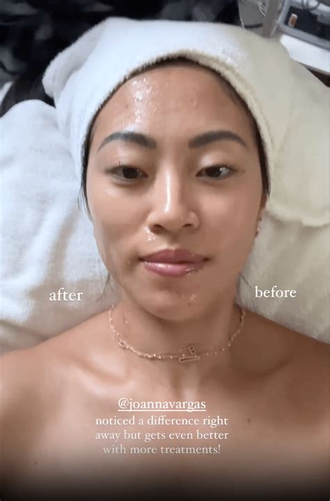 The Rise Of Microcurrent Technology In Skincare A Natural Facelift Re