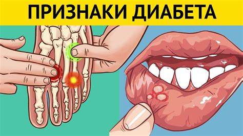 10 ранних признаков того что у вас ДИАБЕТ Многие игнорируют эти симптомы Профилактика диабета