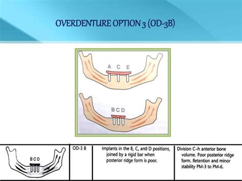 Implant Supported Overdentures PPTX