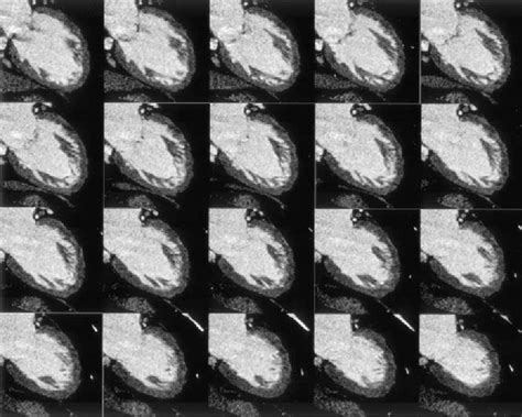 Figure 2 From Papillary Muscles Do Not Attach Directly To The Solid Heart Wall Semantic Scholar