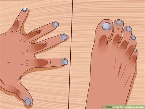 How To Diagnose Lupus With Pictures Wikihow