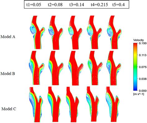 Frontiers Hemodynamic Evaluation Of Endarterectomy And Stenting Treatments For Carotid Web