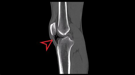 Knee Laceration Repair Cpt Code At Keith Linkous Blog