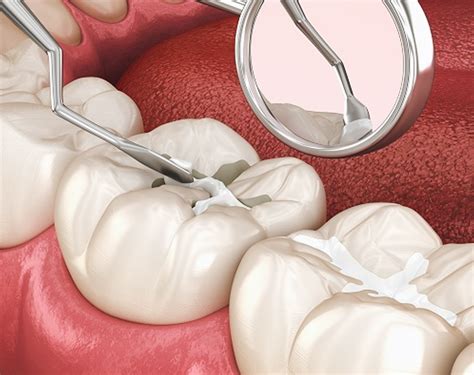Dental Sealants Dental Docs In Connecticut