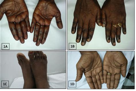 Anemia Skin Discoloration