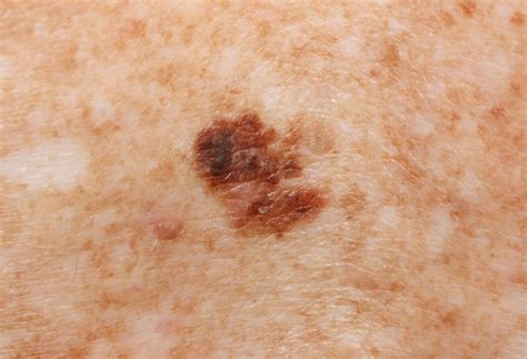 Melanoma Symptoms At Autumn Allen Blog