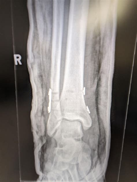 Suture Button Versus Screw Fixation R Brokenbones