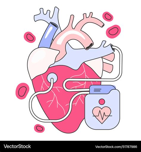 artificial cardiac pacemaker medical device vector image