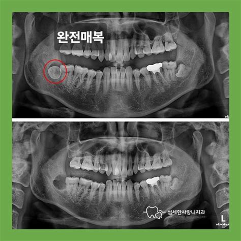 경주 완전 매복 사랑니 발치는 어떻게 하나요 네이버 블로그