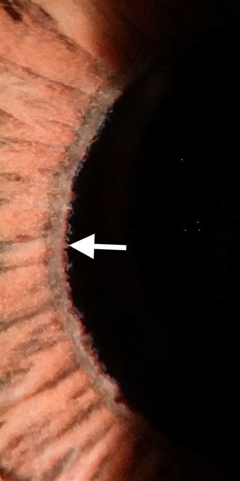 PEX syndrome Oční atlas