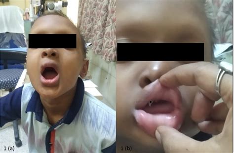 A Rare Case Of Anhydrous Ectodermal Dysplasia