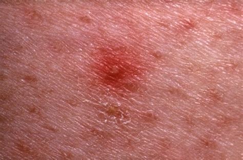 13 Causes Of Red Spots On The Skin — Medipulse Best Private Hospital