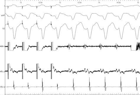 Mapping Fundamentals Electrograms And Entrainment