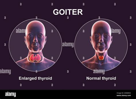 3d Illustration Of A Person With An Enlarged Thyroid Gland Base Of Neck Known As A Goiter