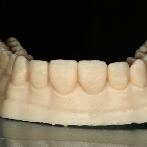 Pdf Accuracy Of Direct Composite Veneers Via Injectable Resin Composite And Silicone Matrices