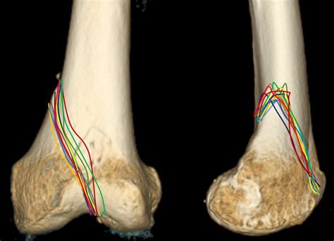 This Image Shows The Superimposed Fracture Lines Of All 13 Fractures In