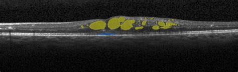Heidelberg Engineering And Retinsight To Offer Ai Based Oct Fluid Quantification Solution